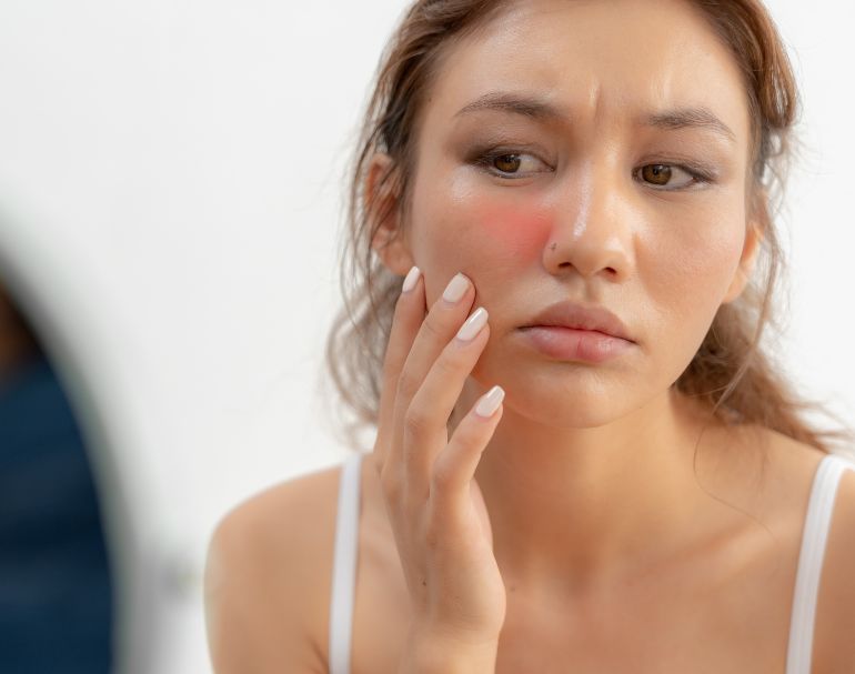 Macchie rosse sulla pelle con prurito, come trattarle? - Parafarmacia Manas